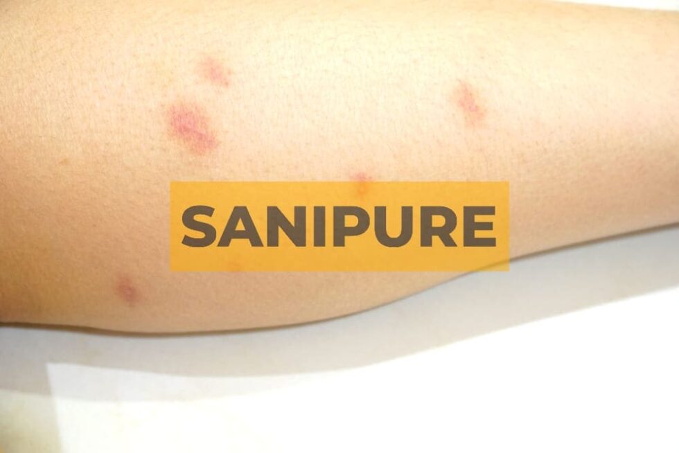 Comment sont les boutons des punaises de lit?